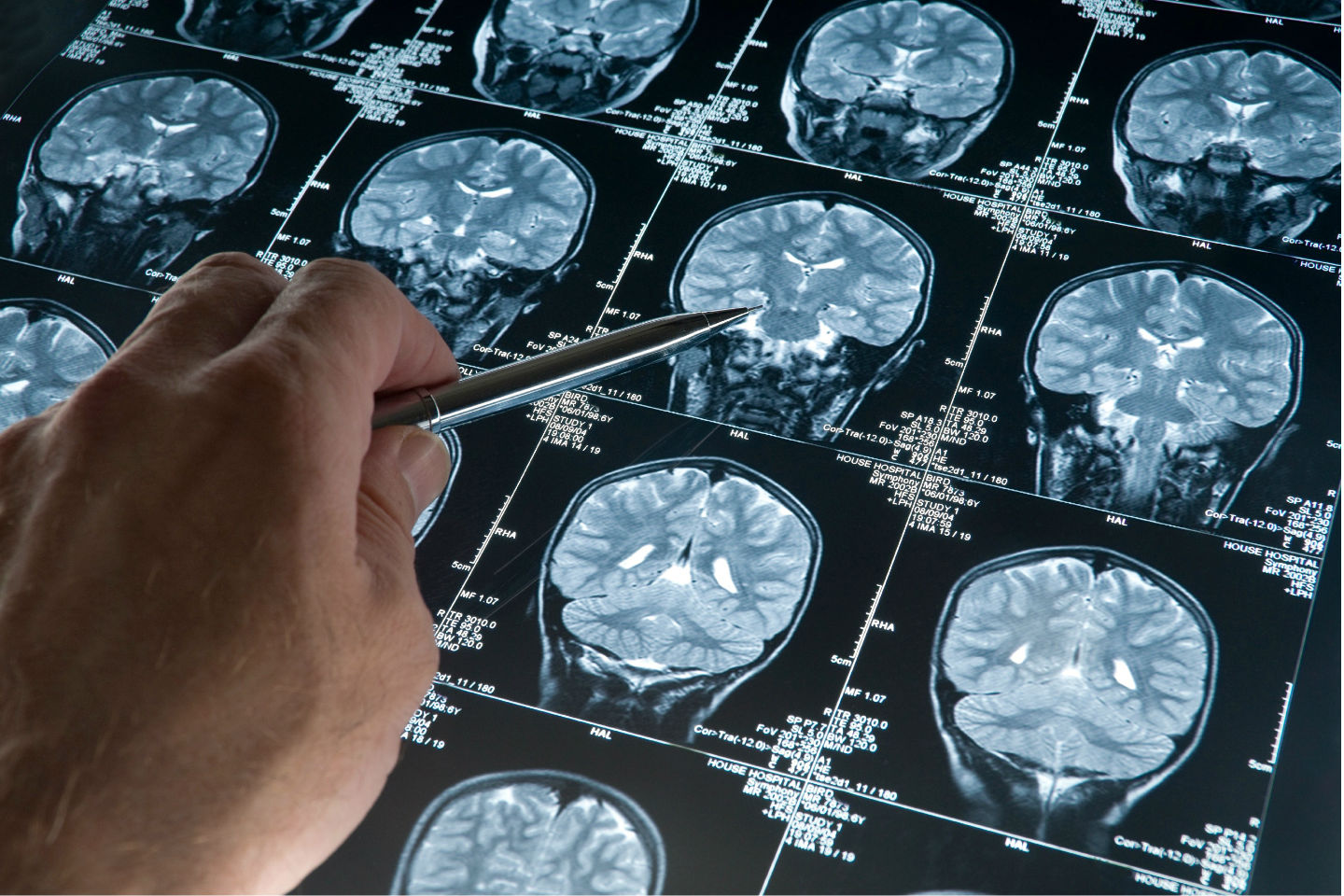 Νόσος Alzheimer: Μία σύγχρονη επιδημία - Ιατρικός Σύμβουλος
